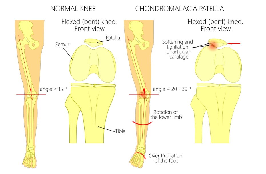 Hidden causes of low back pain and sciatica - part 4: your feet ...